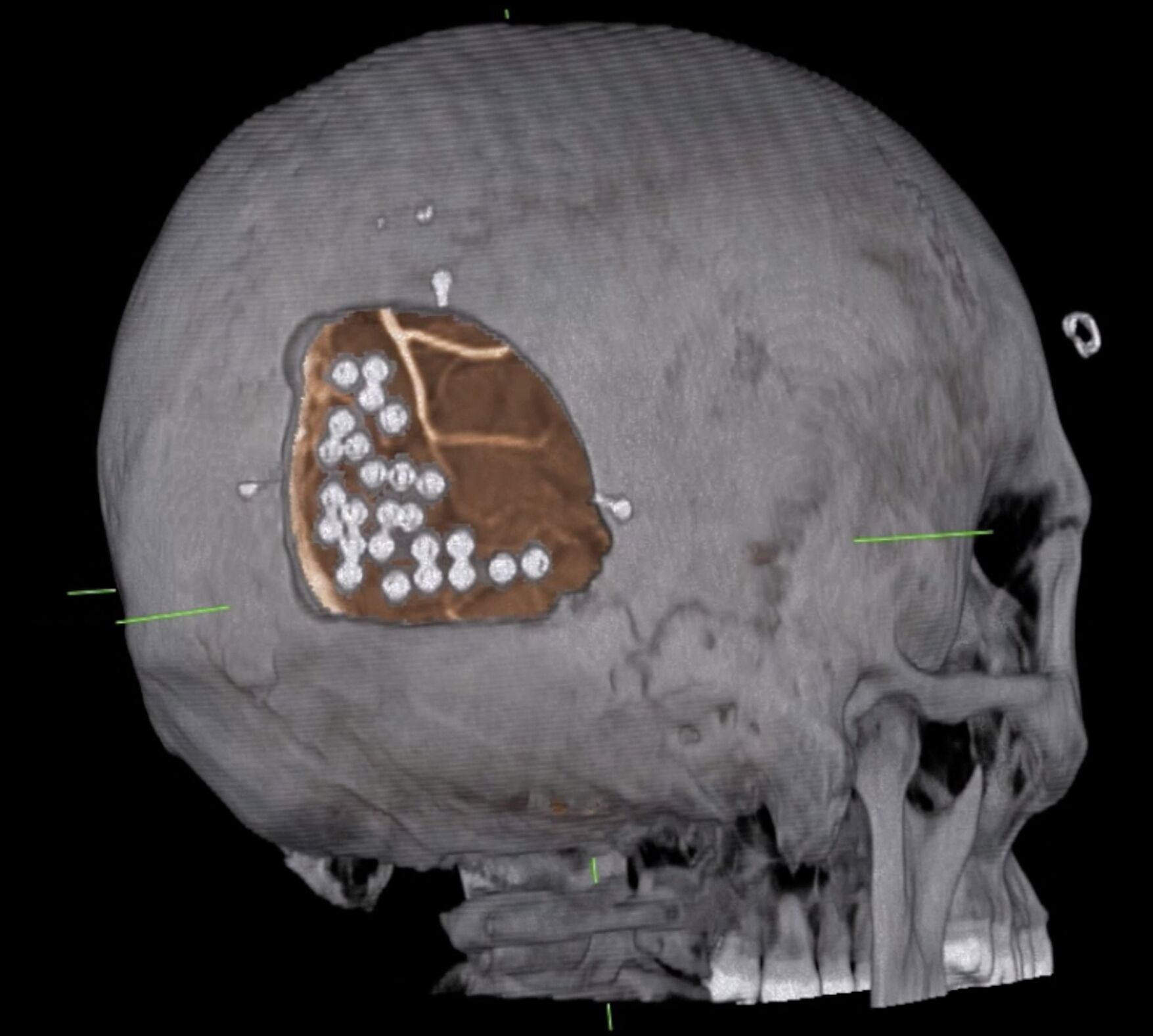 Intracortical visual prosthesis – Prototypes for Humanity